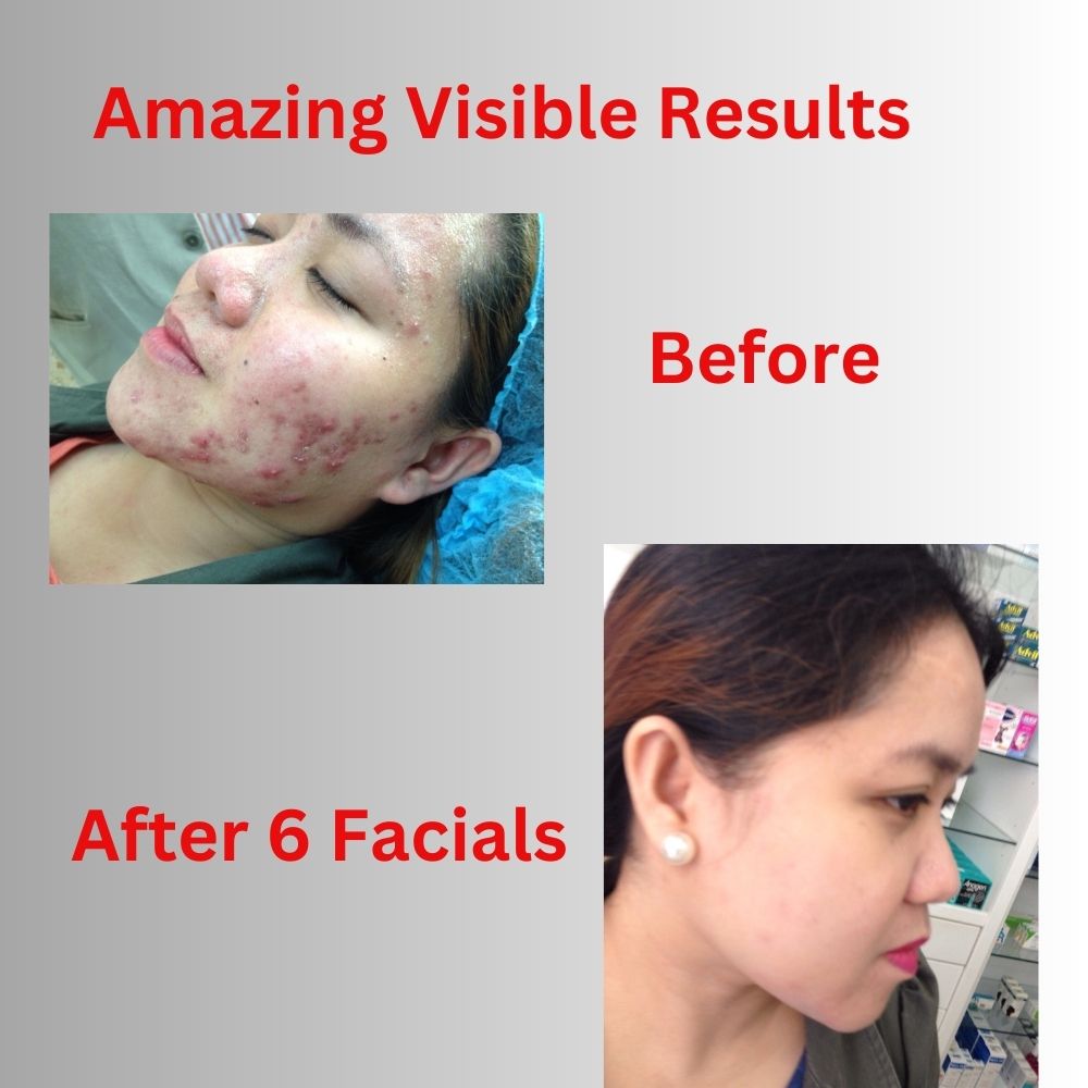 Acne Treatment Kit - Best Acne Treatment Products Online – Pharmaclinix